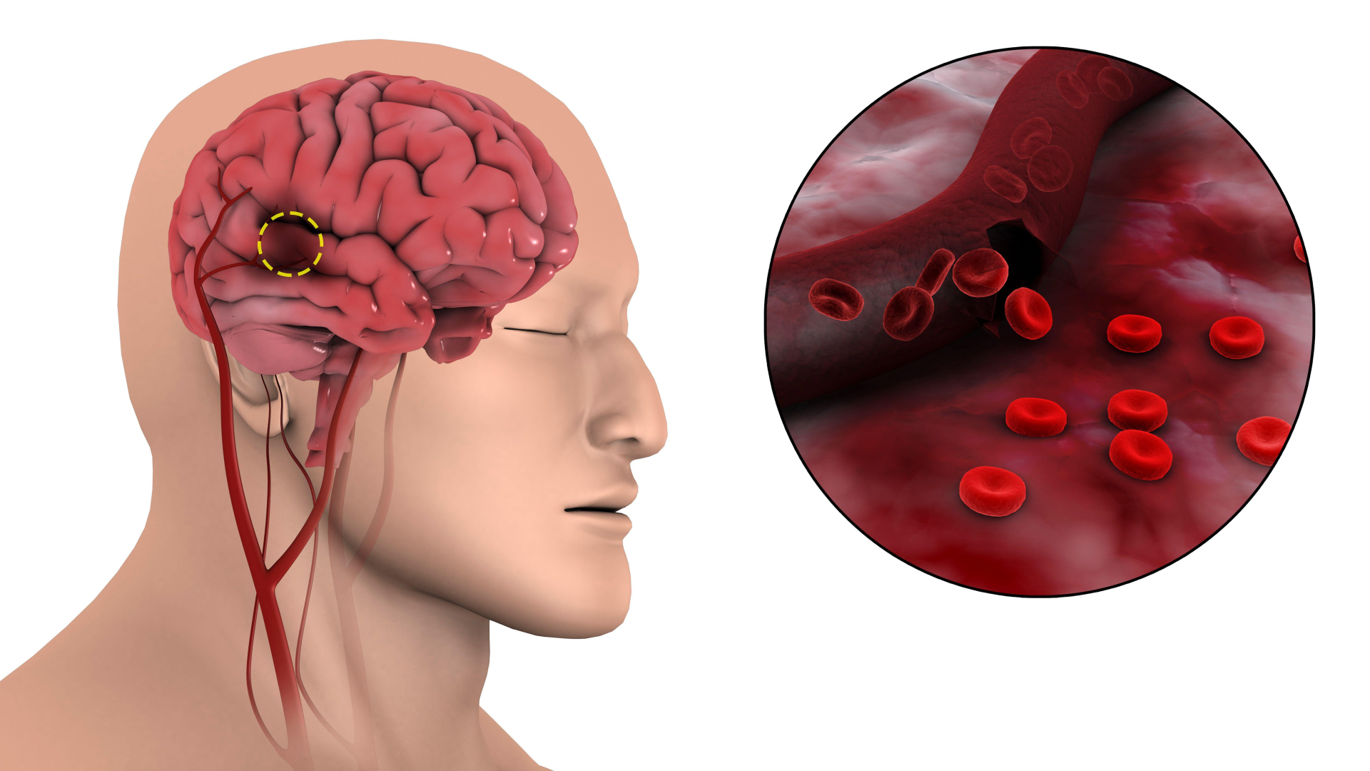 Beyne Pıhtı Atması Nedir ? Belirtileri Nelerdir? - Bilgi Rehberi Beyne Pıhtı Atması Nedir ? Belirtileri Nelerdir? - Bilgi Rehberi